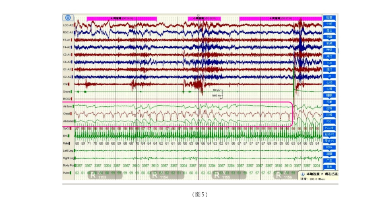 病例分享|拳打脚踢的睡眠-警惕神经系统退行性疾病_睡眠障碍