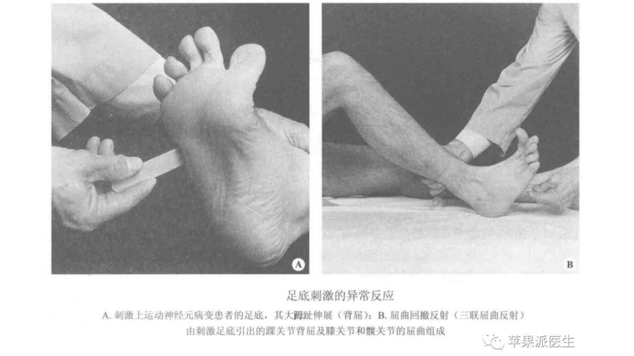 理解Babinski征，划对Babinski征_神经系统疾病