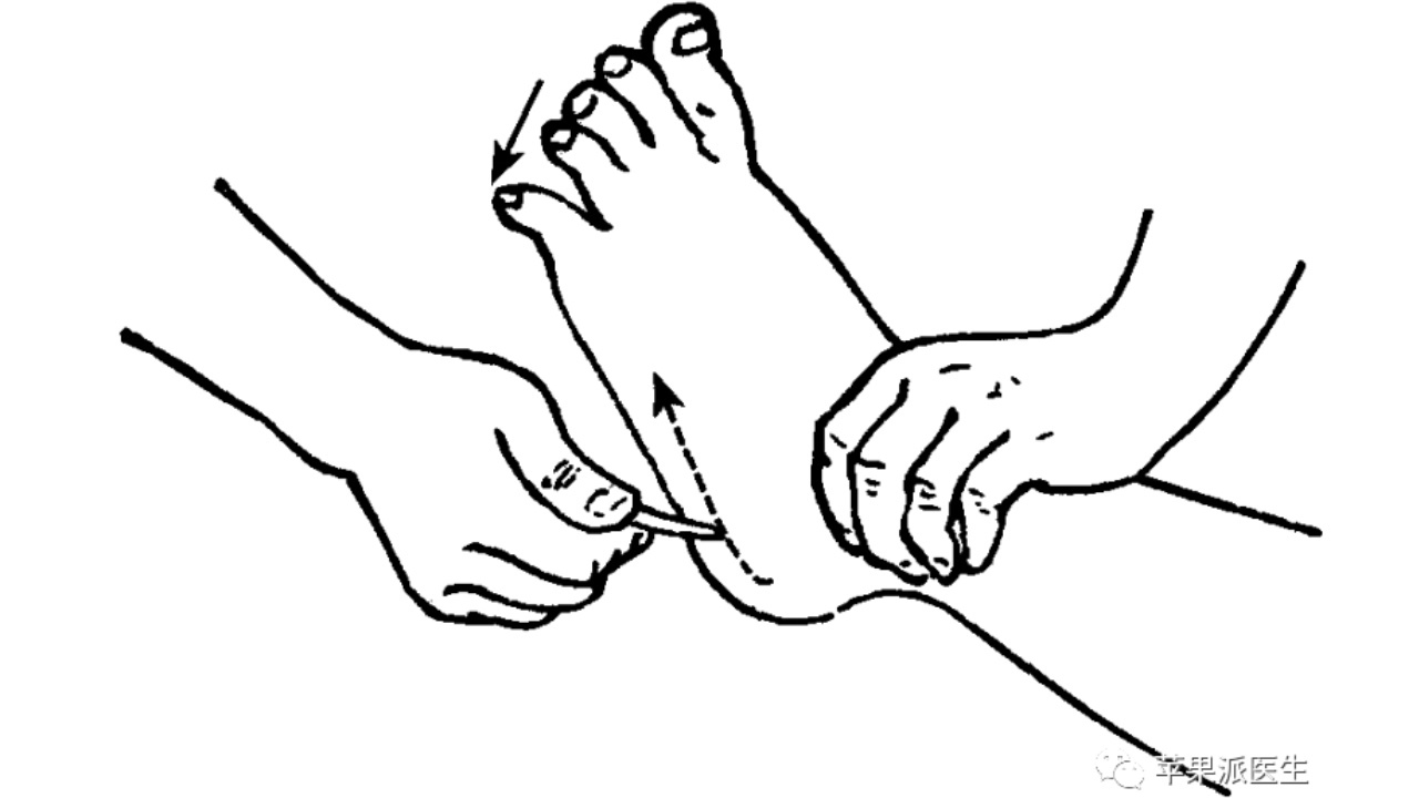 理解Babinski征，划对Babinski征_神经系统疾病