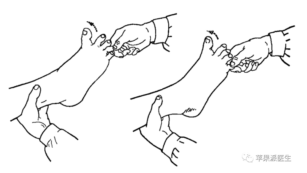 理解Babinski征，划对Babinski征_神经系统疾病