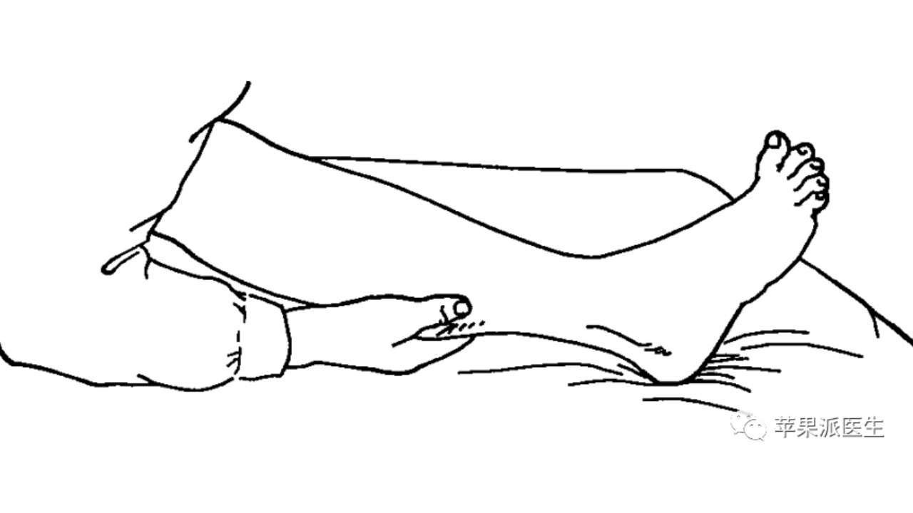 理解Babinski征，划对Babinski征_神经系统疾病