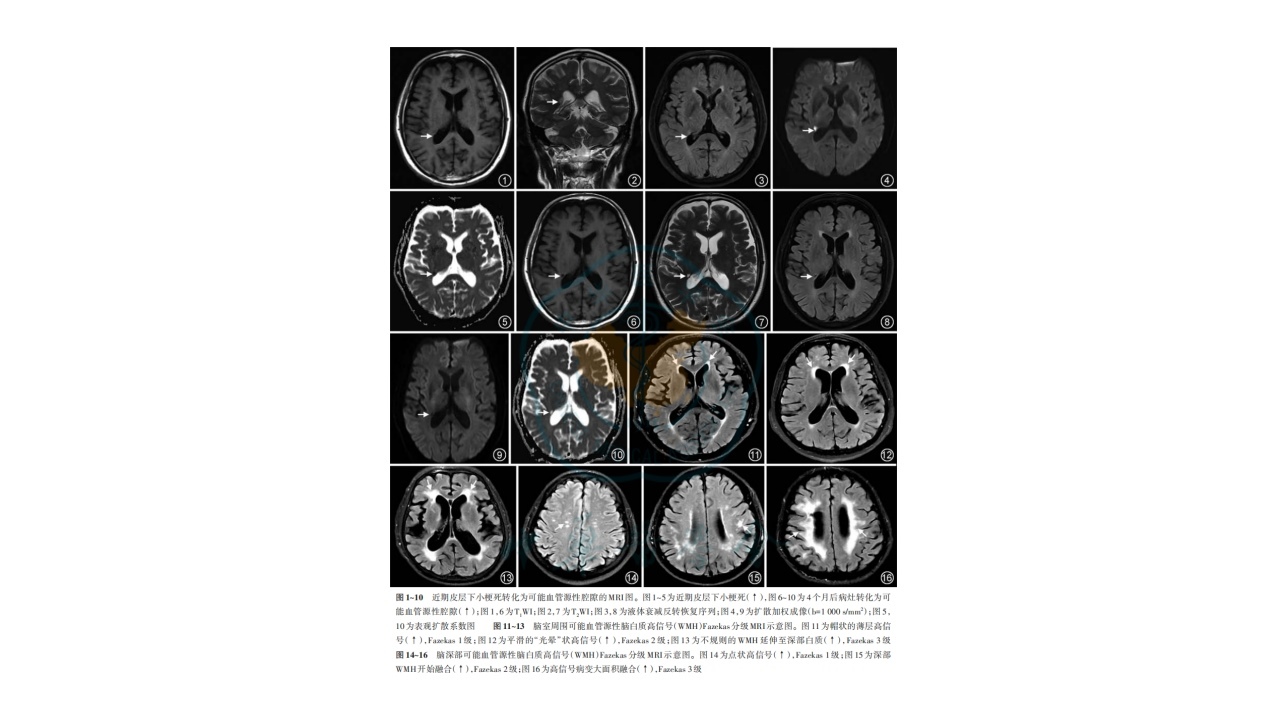 脑小血管病（CSVD）MRI规范化应用_脑血管病